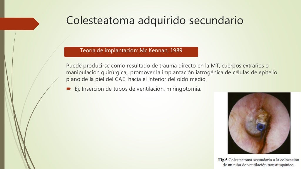 Colesteatoma