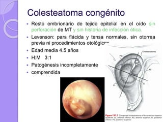 Colesteatoma | PPT
