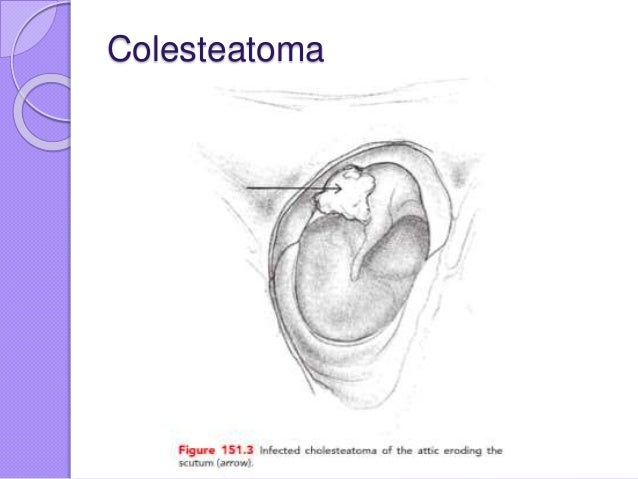 Colesteatoma