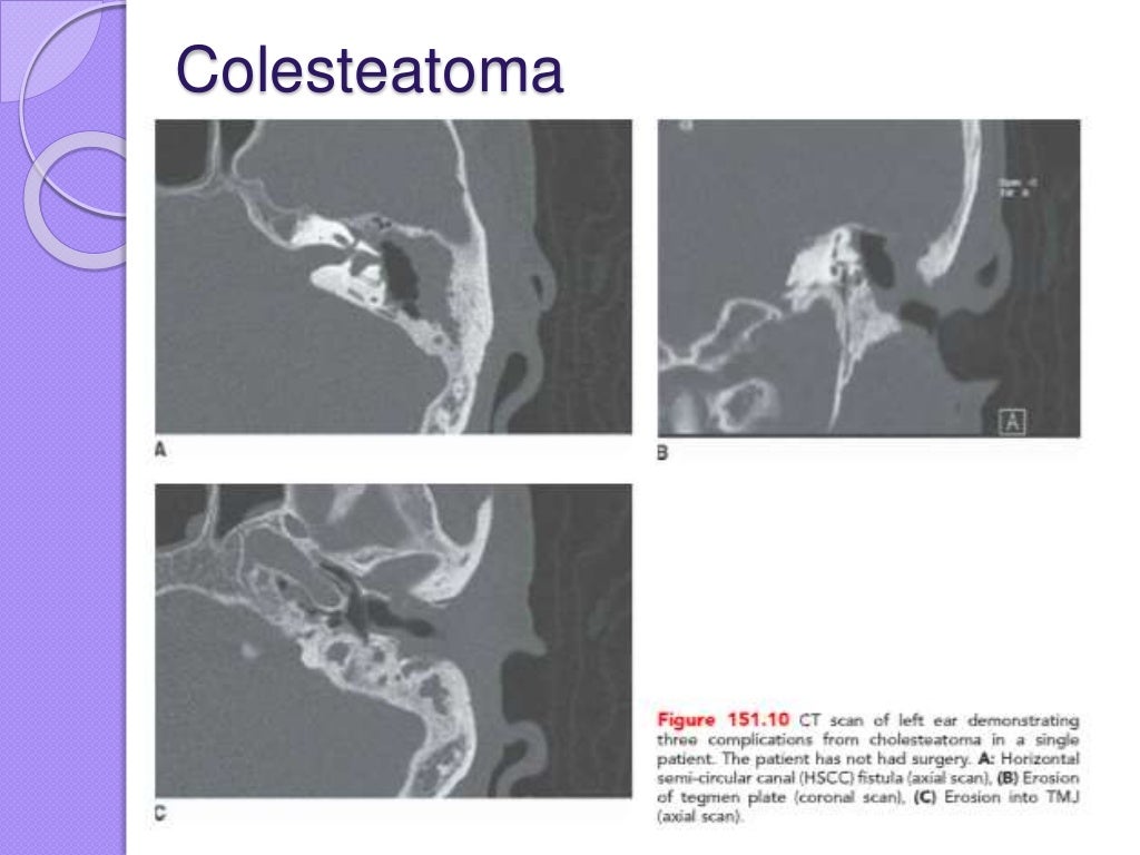 Colesteatoma