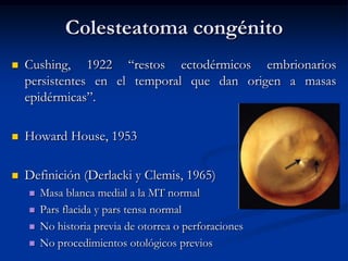 Colesteatoma | PPTX