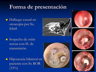Colesteatoma | PPTX