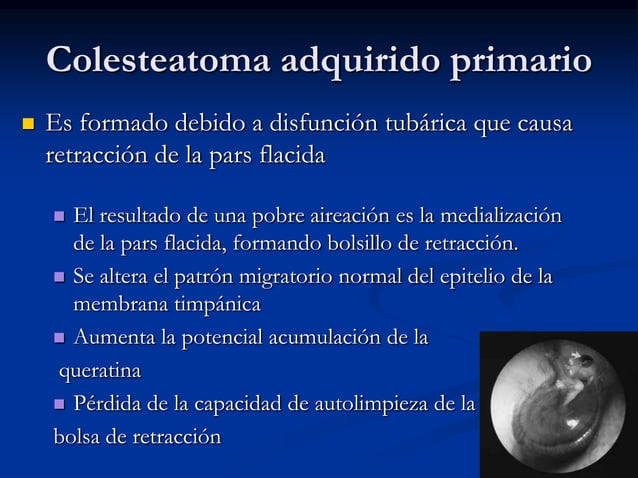 Colesteatoma | PPTX