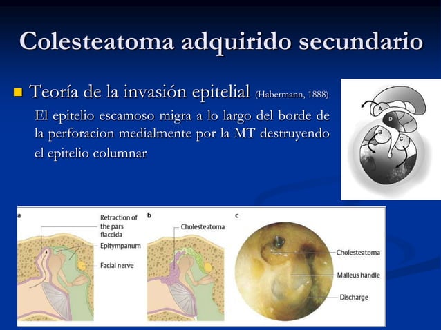 Colesteatoma | PPTX