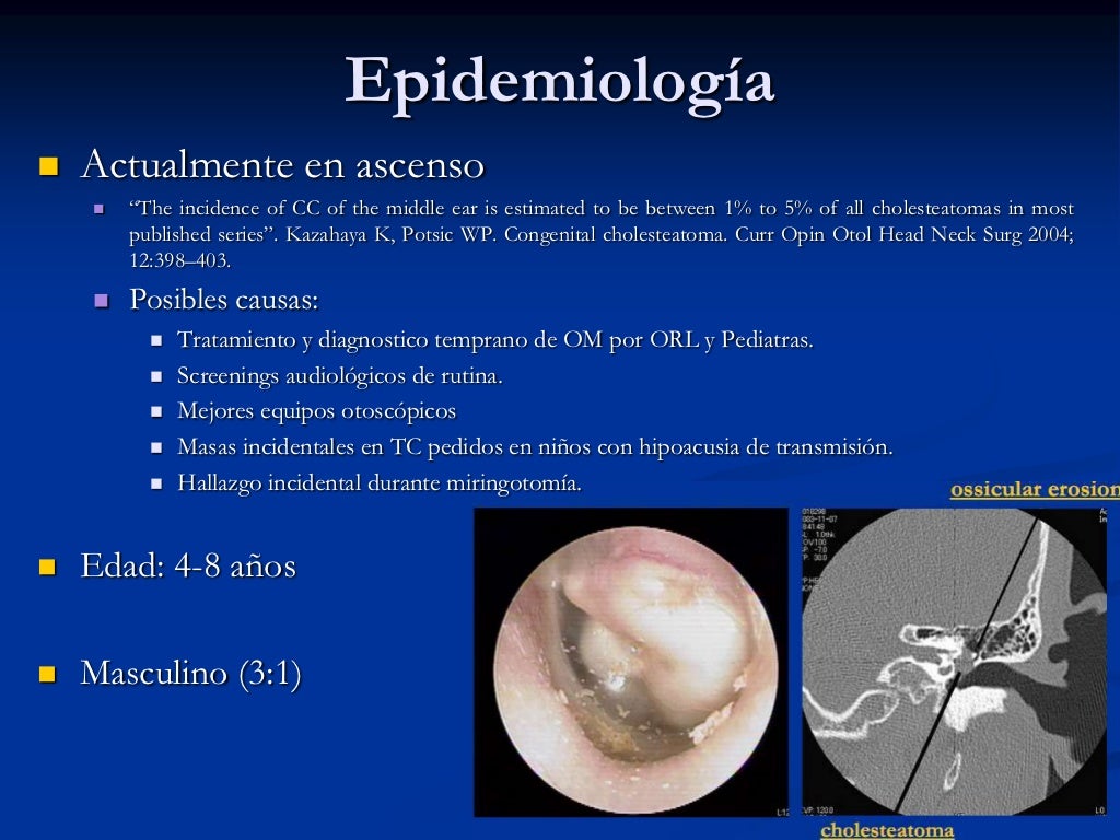 Colesteatoma: O Que É, Sintomas, Causas E Tratamento – OIDK