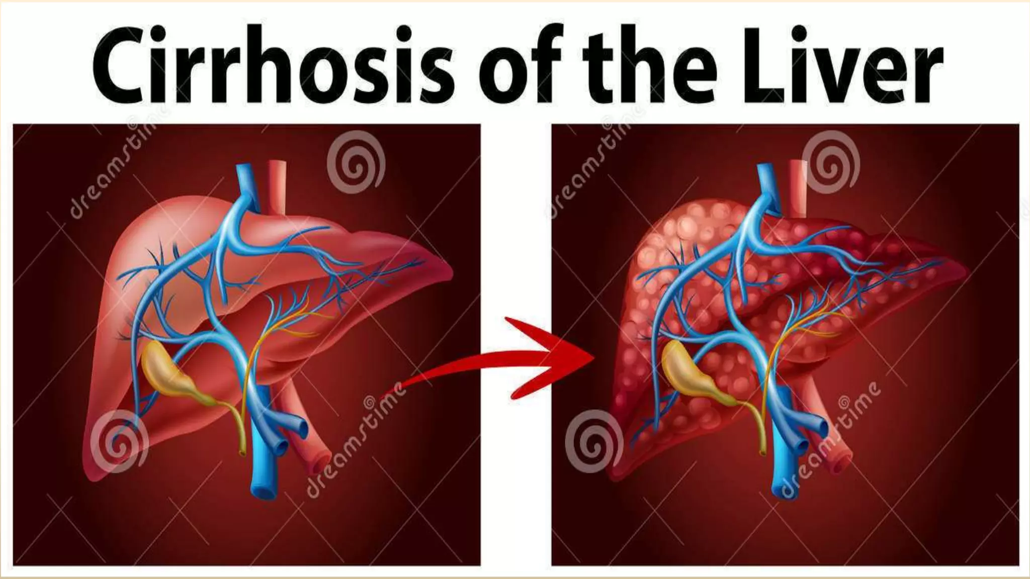 Cirrhosis of Liver | PPT