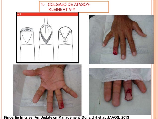 Colgajos cutaneos expo