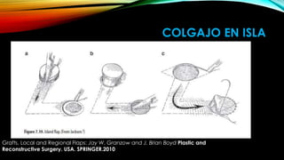 Colgajos fasciocut cmc | PPTX