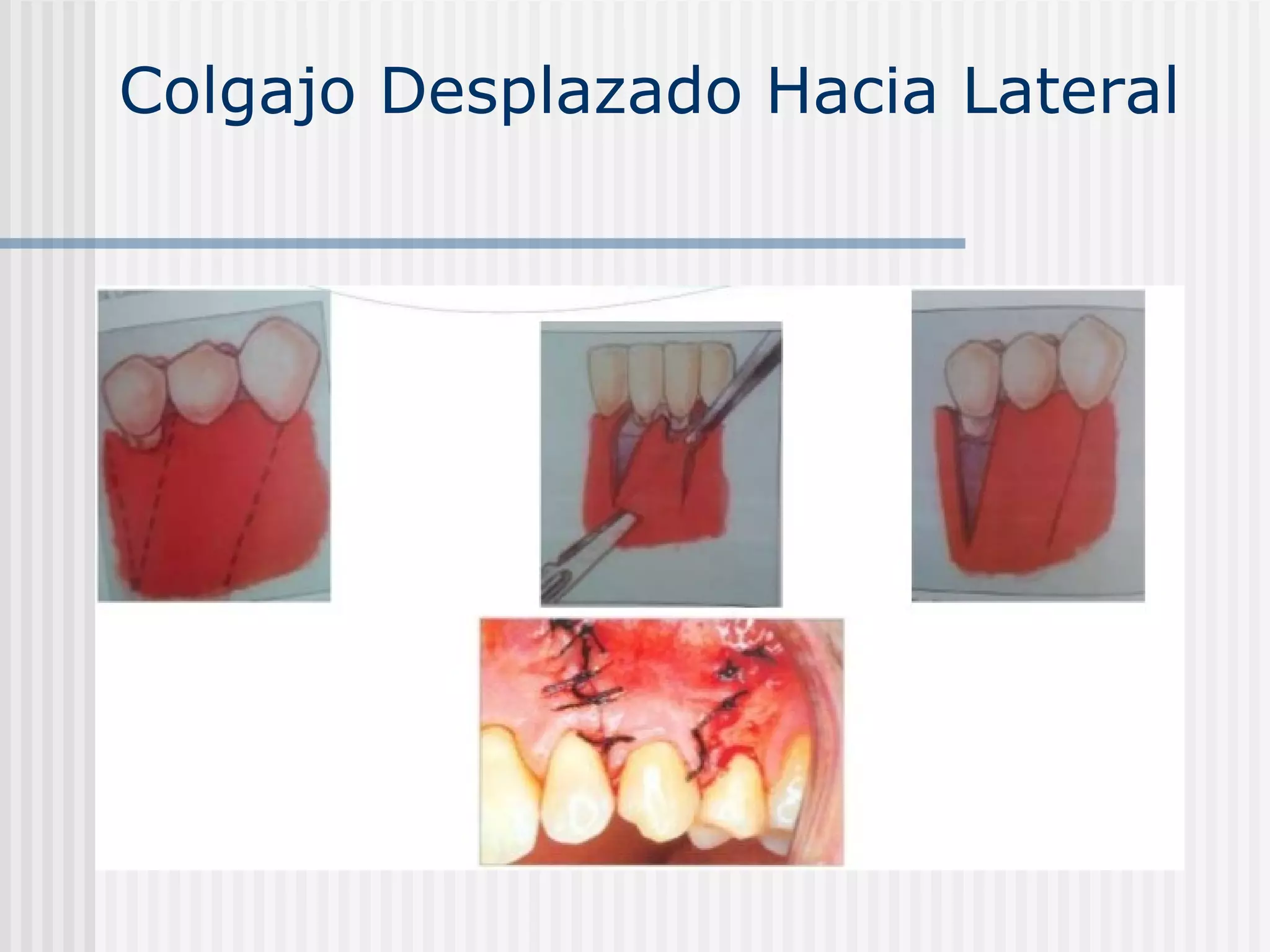 Colgajos periodontales | PPT