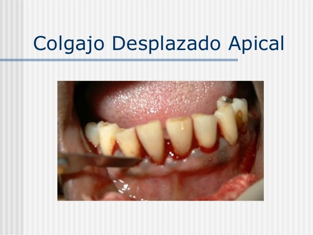 Colgajos periodontales