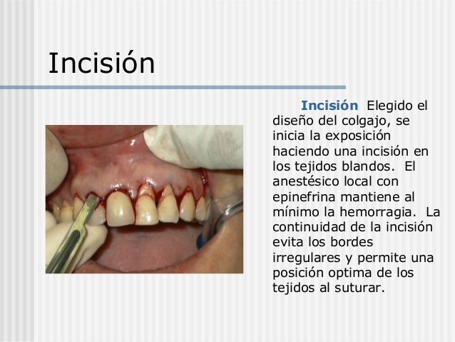 Colgajos periodontales