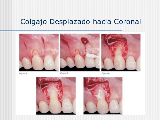 Colgajos periodontales