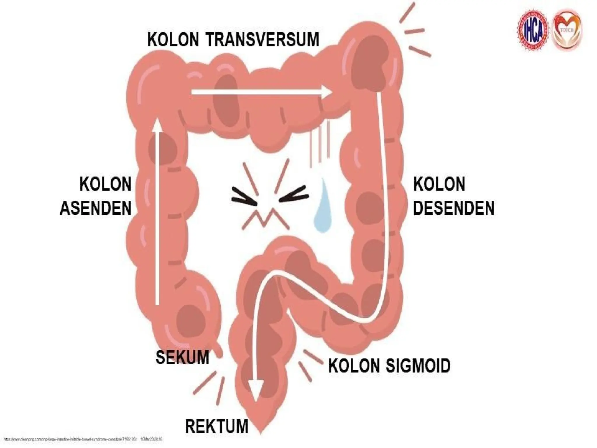 Colic Abdomen, konstipasi dan kembung.pptx