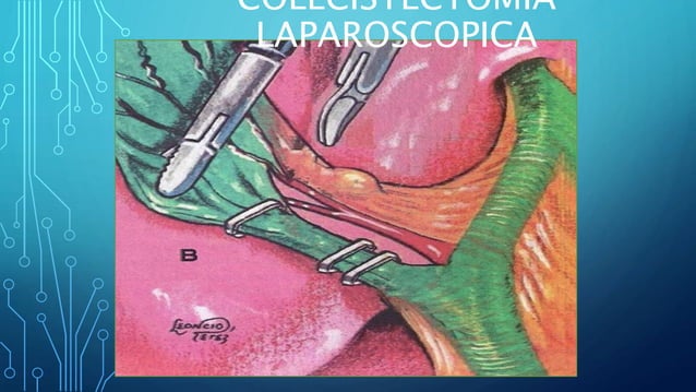 Colicistectomia | PPT