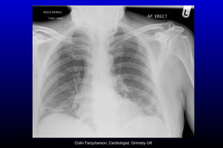 Colin Farquharson - leptospirosis presentation | PPT | Heart and ...