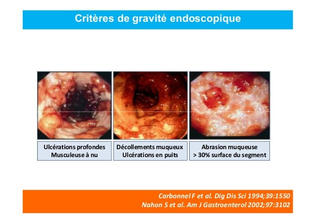 Colites aiguës graves | Ali JENDOUBI, MD | 2017