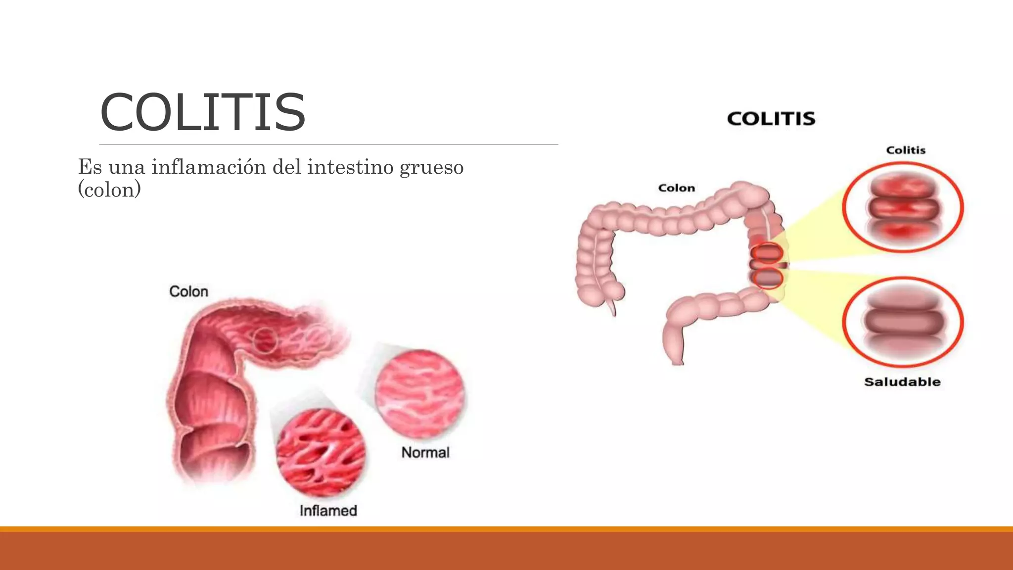 Colitis ulcerativa y nerviosa | PPTX