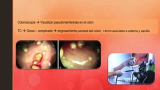COLITIS PSEUDOMEMBRANOSA Y SHIGELOSIS | PPTX