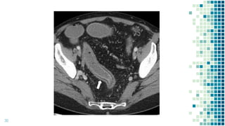 Colitis ulcerativa | PPTX