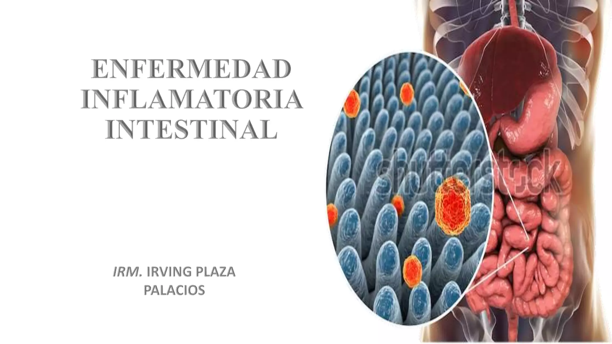 Colitis ulcerativa | PPTX