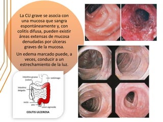 Colitis ulcerativa | PPTX
