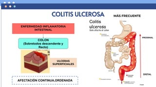 COLITIS ULCEROSA.pdf