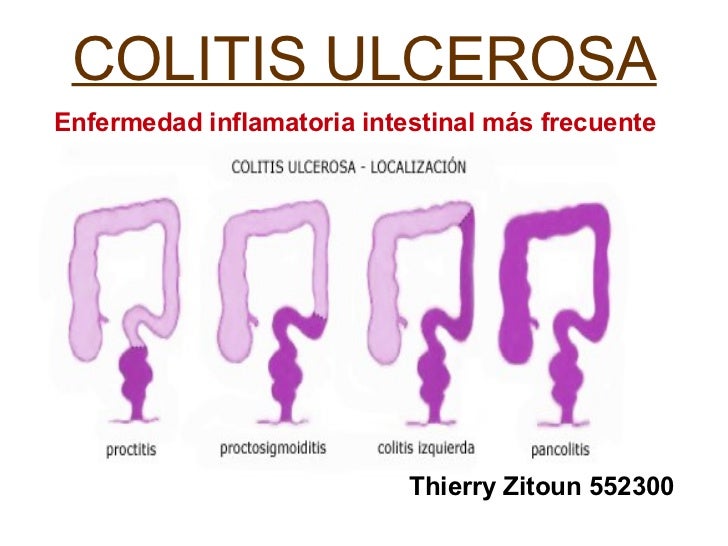 Colitis ulcerosa
