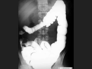 Colitis Ulcerosa Crónica Idiopática CUCI.pptx