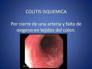 Colitis y su clasificacion | PPTX