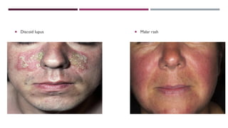 collagen and its disorders _.pdf