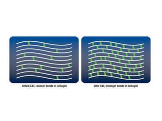 Collagen cross linking | PPTX