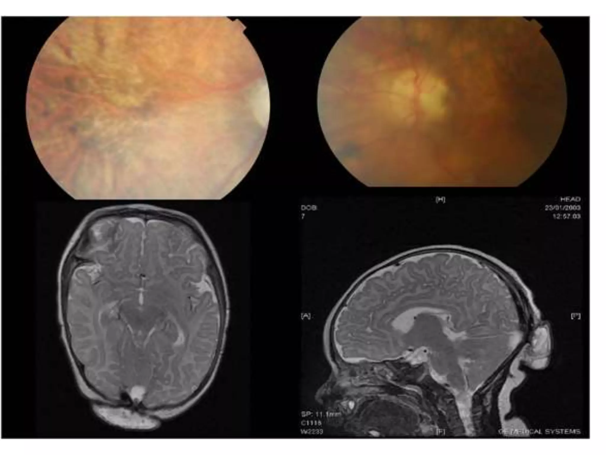 Collagen disorders in neurology | PPT