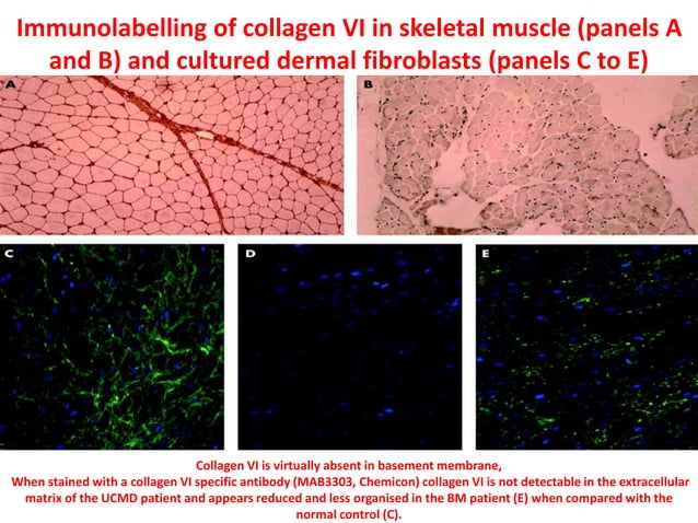 Collagen disorders in neurology | PPT