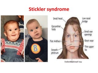 Stickler Syndrome Symptoms