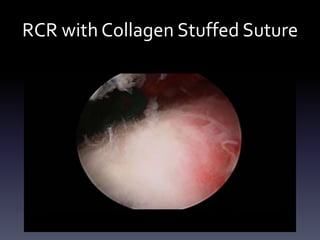 Collagen Stuffed Sutures Enhance Healing of Full-Thickness Rotator Cuff ...