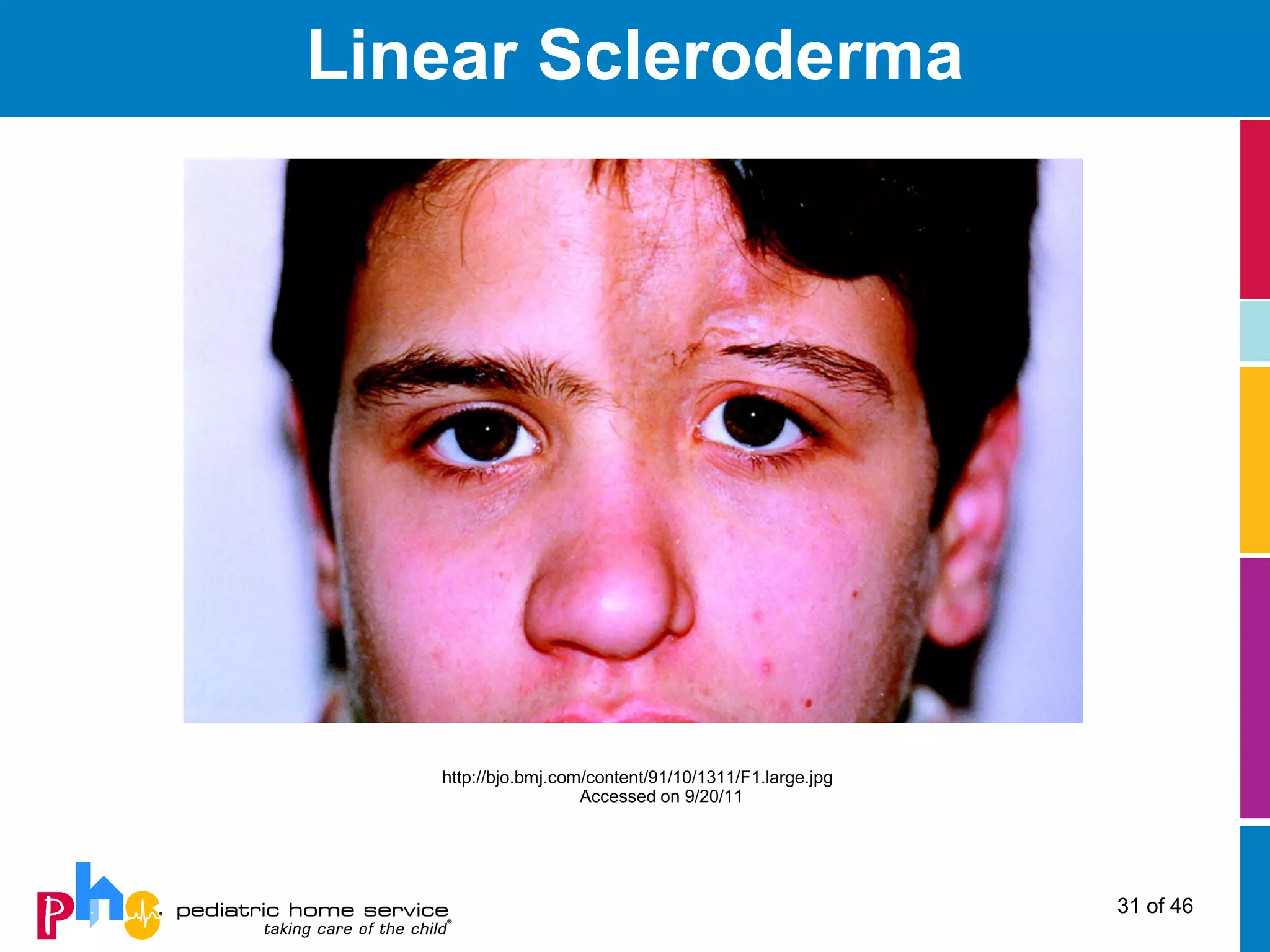 Collagen Vascular Disease in Children | PDF