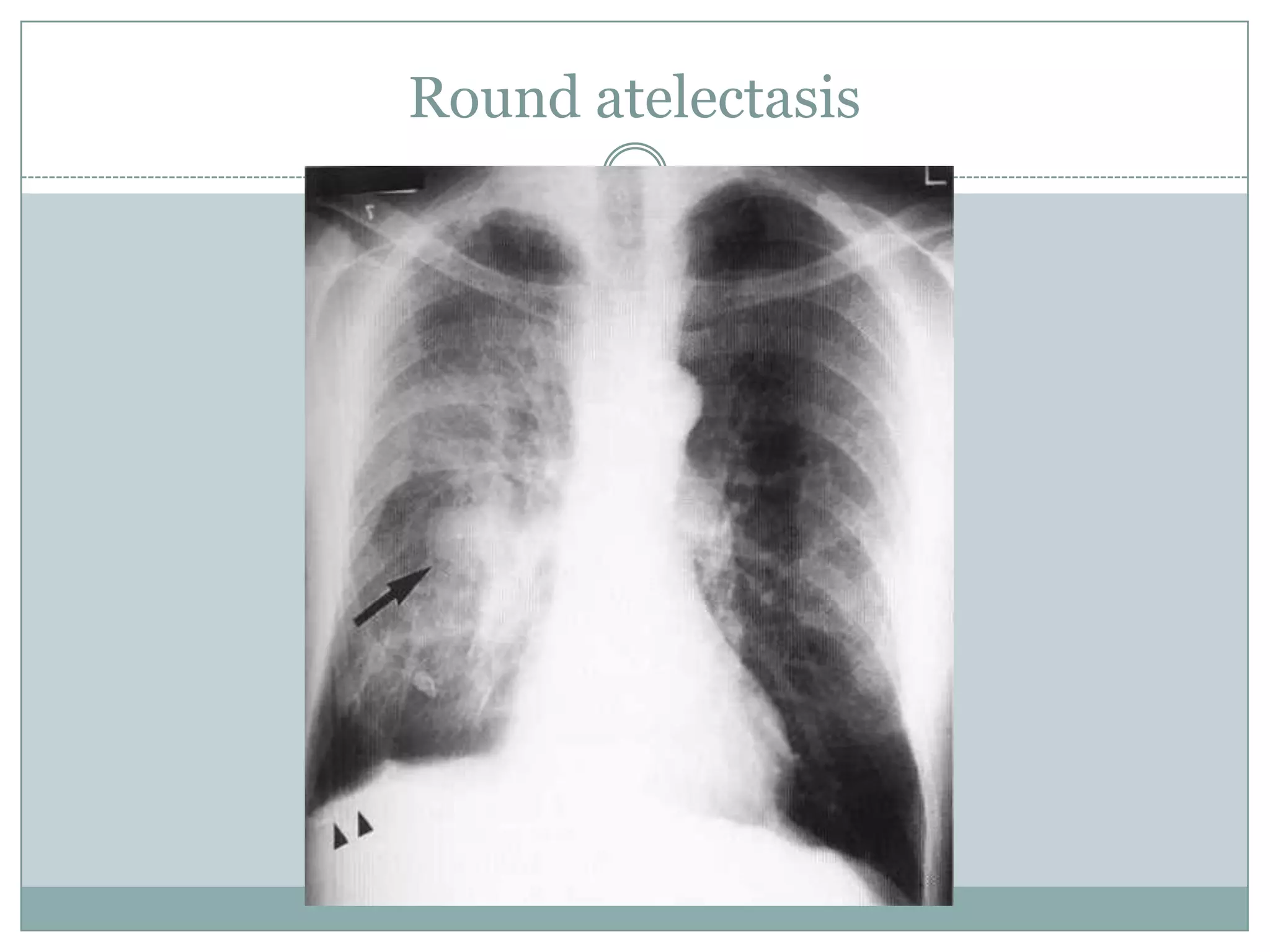 chest radiography: Collapse | PPTX