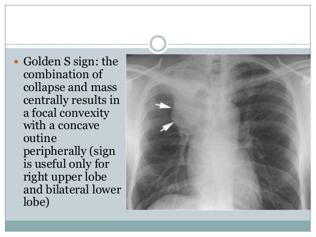 chest radiography: Collapse