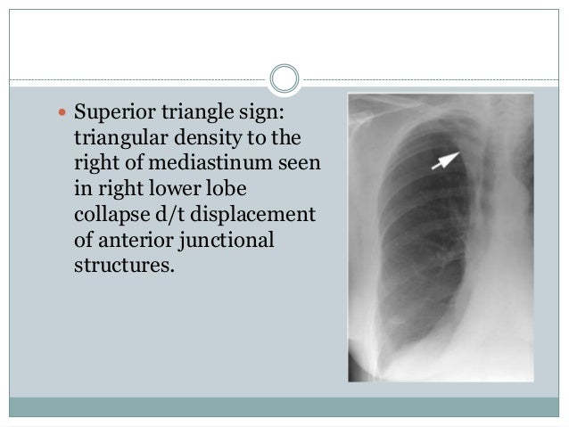 chest radiography: Collapse