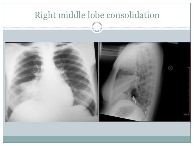 chest radiography: Collapse