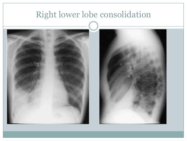 chest radiography: Collapse
