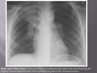 Collapse- RADIOLOGY | PPTX