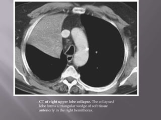 Collapse- RADIOLOGY | PPTX