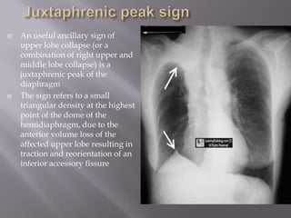 Collapse- RADIOLOGY | PPTX