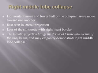 Collapse- RADIOLOGY | PPTX