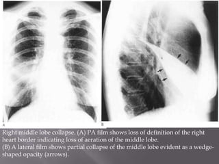Collapse- RADIOLOGY | PPTX