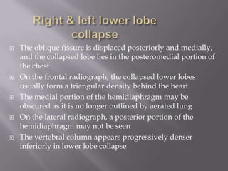 Collapse- RADIOLOGY | PPTX
