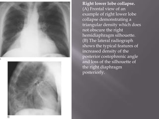 Collapse- RADIOLOGY | PPTX