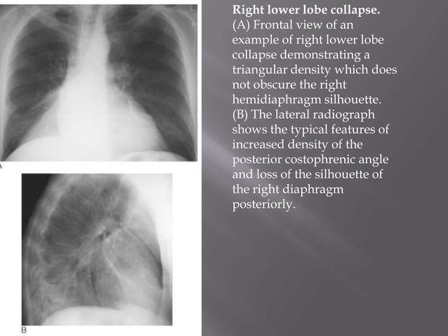 Collapse- RADIOLOGY | PPTX