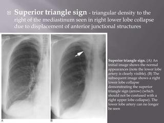 Collapse- RADIOLOGY | PPTX